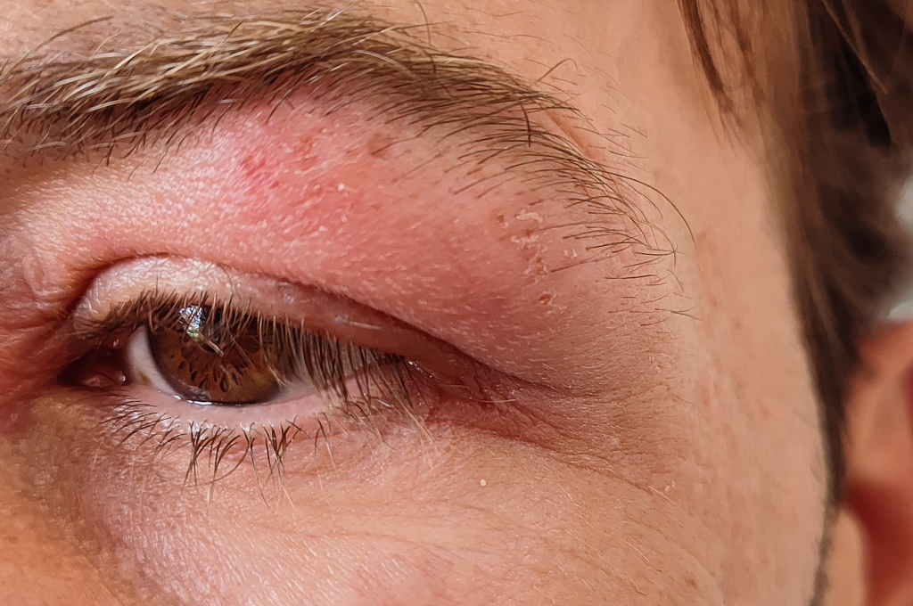 Tipos de blefaritis: Descubre si tienes esta infección